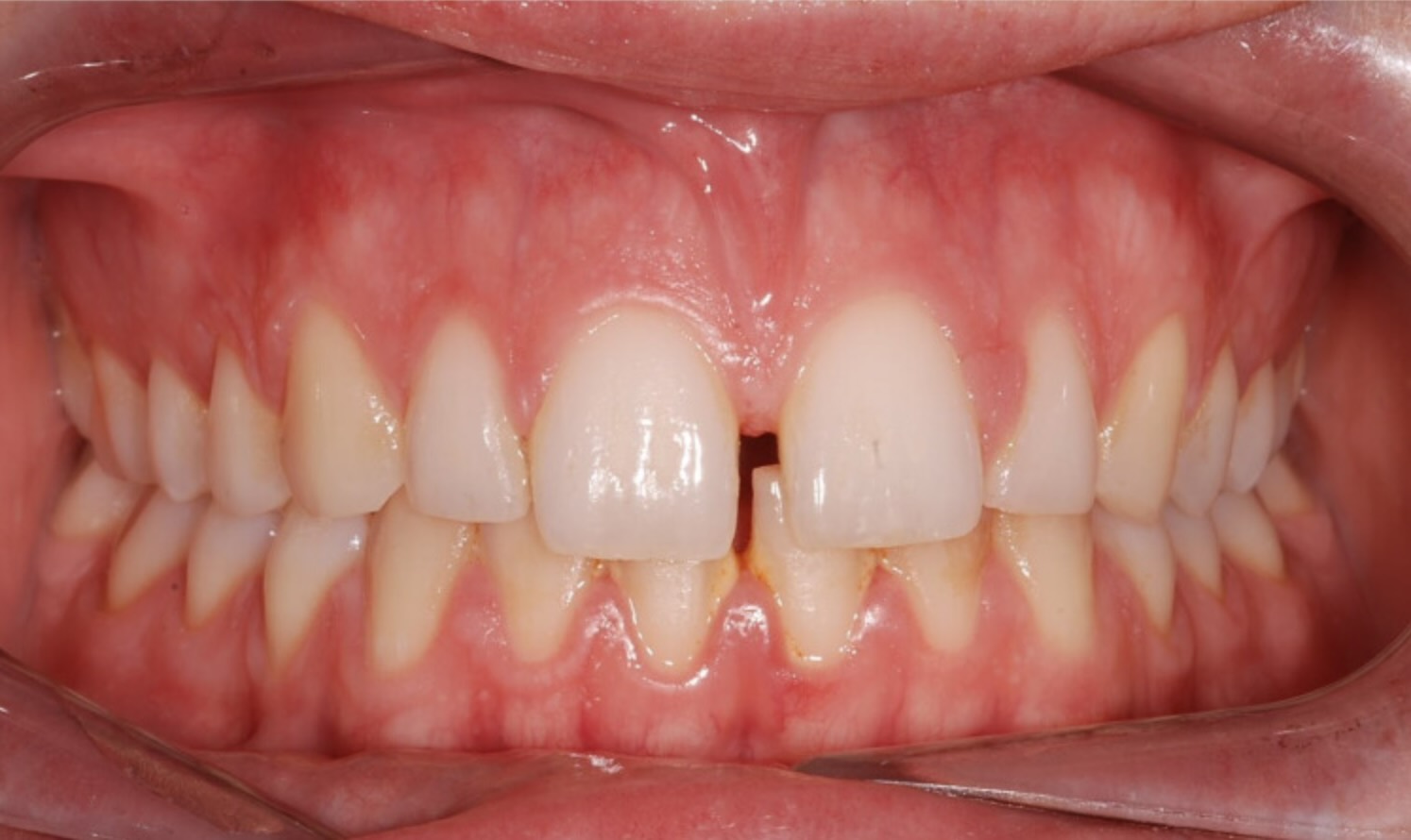 Diastema, correzione con ortodonzia linguale invisibile - Gabriele ...